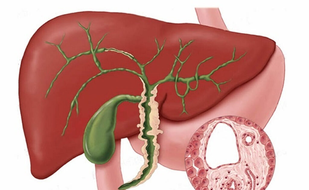 Seladelpar Shows Promising Results for Patients with Primary